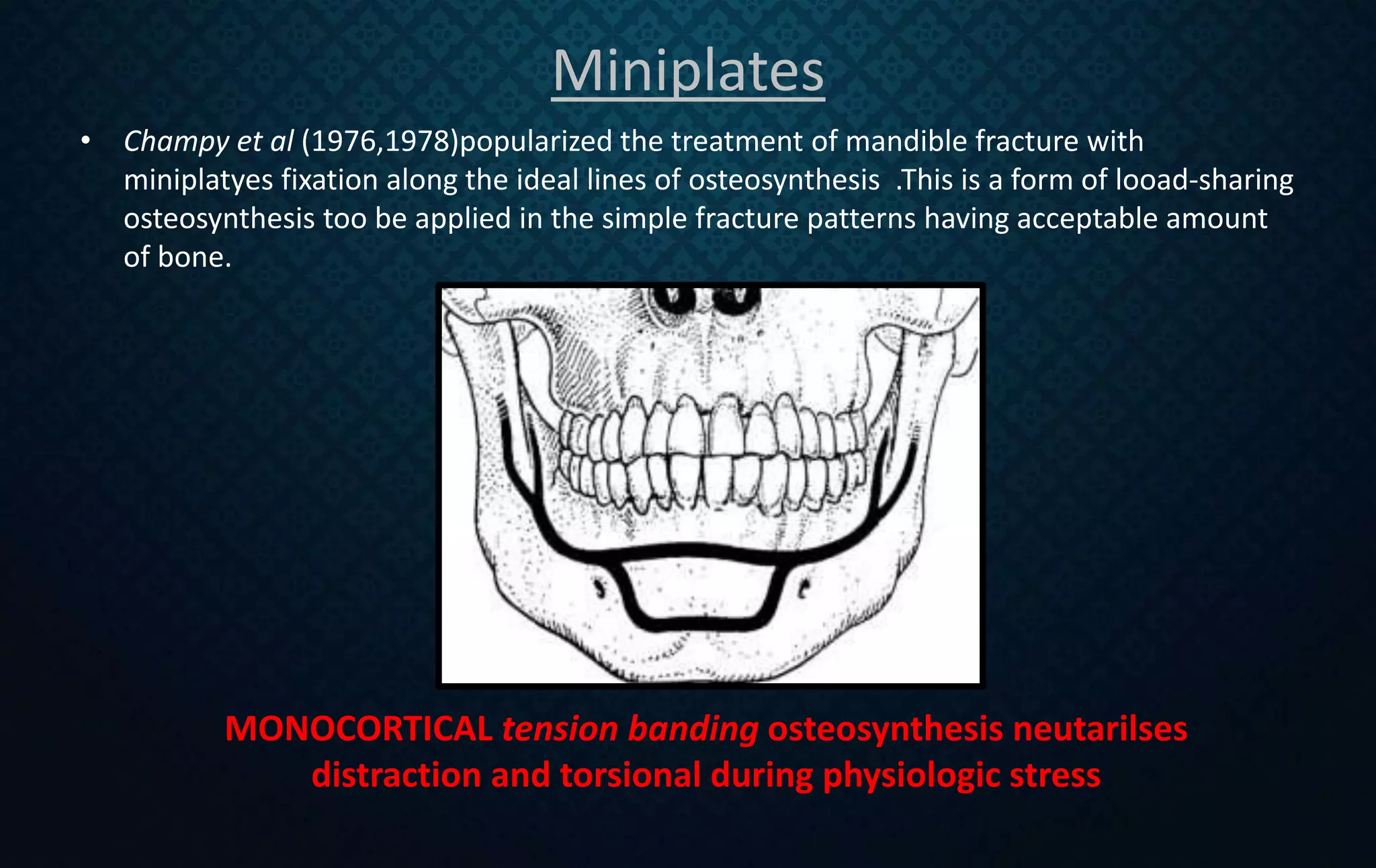 Rigid internal fixation | PPTX