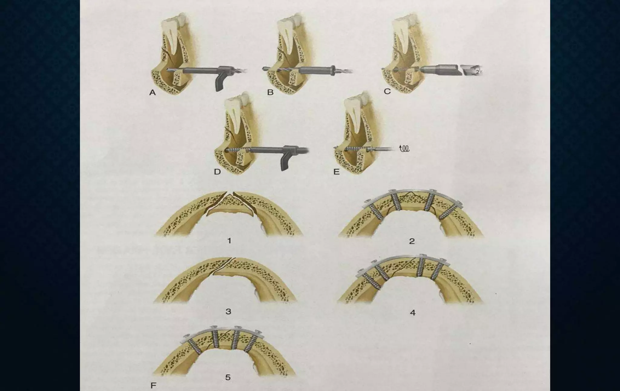 Rigid internal fixation | PPTX