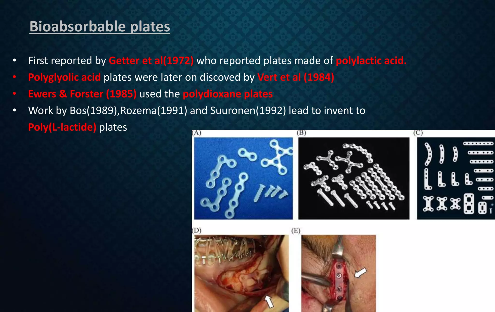 Rigid internal fixation | PPTX