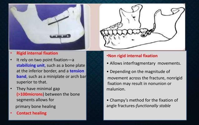 Rigid internal fixation | PPTX