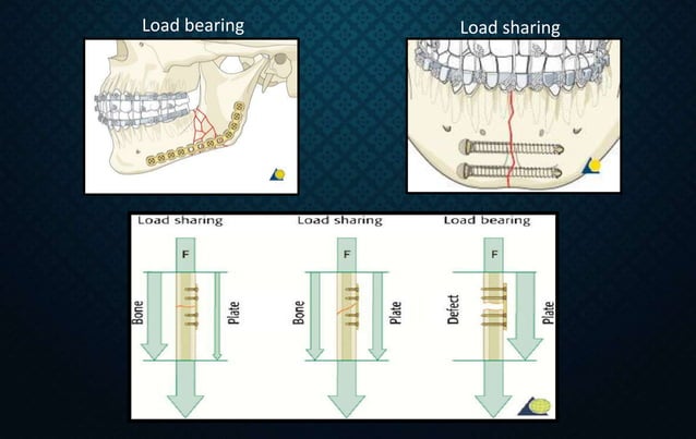 Rigid internal fixation | PPTX