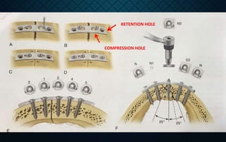 Rigid internal fixation | PPTX