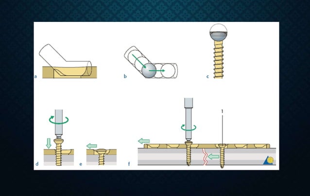 Rigid internal fixation | PPTX