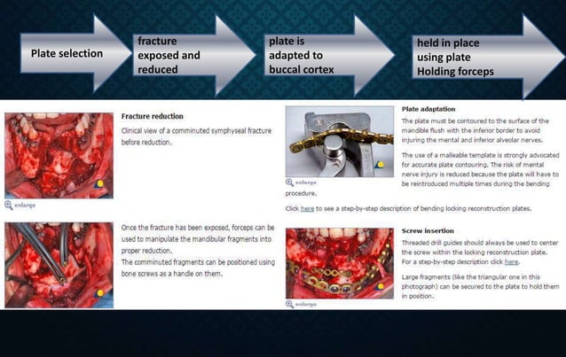 Rigid internal fixation | PPTX