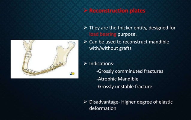 Rigid internal fixation | PPTX