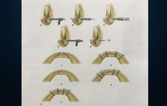 Rigid internal fixation | PPTX