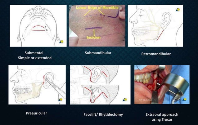 Rigid internal fixation | PPTX