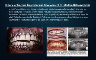 Rigid internal fixation | PPTX