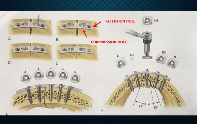 Rigid internal fixation