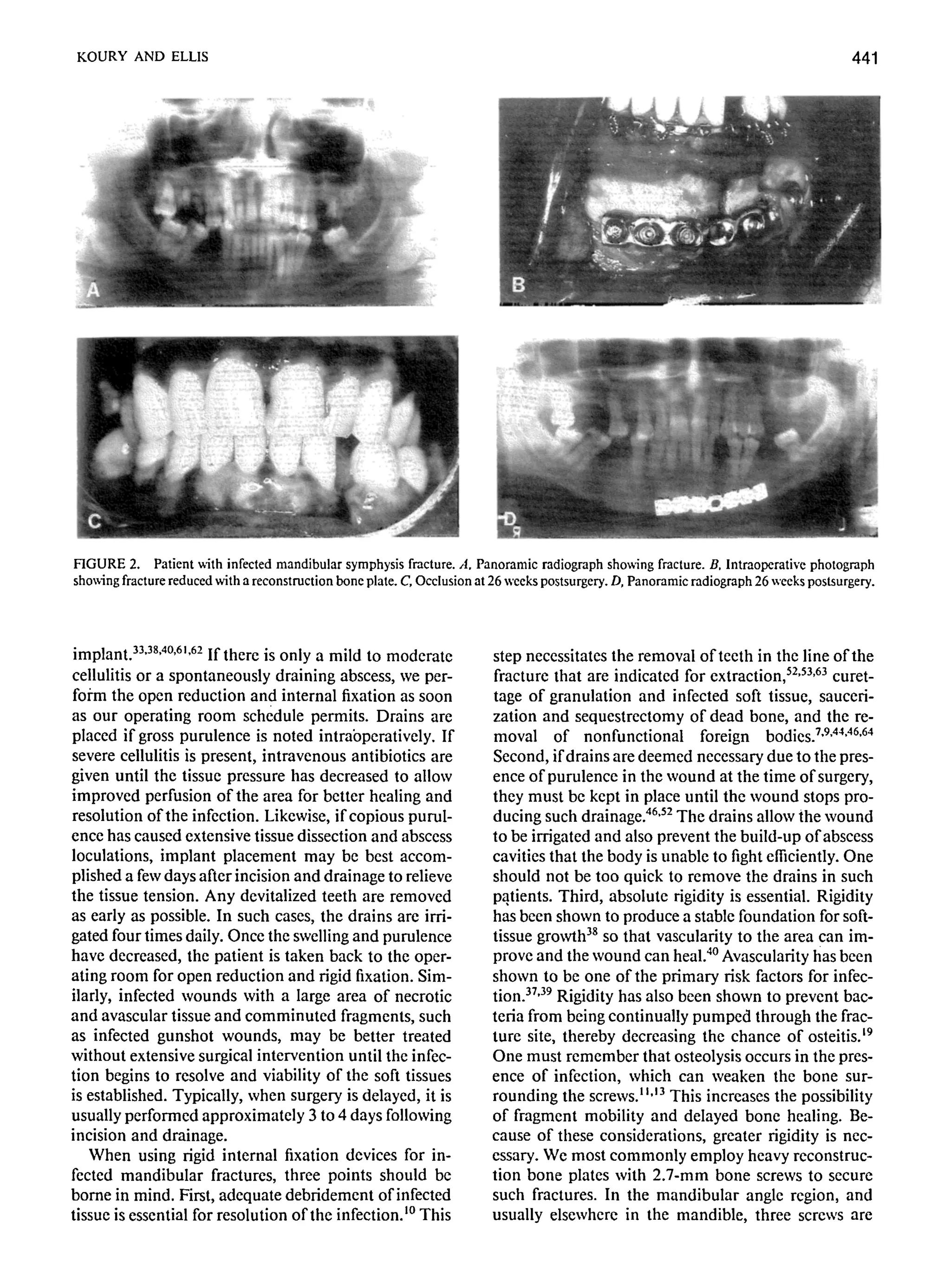 Rigid internal fixation for mandibular of infected mandibular fractures ...
