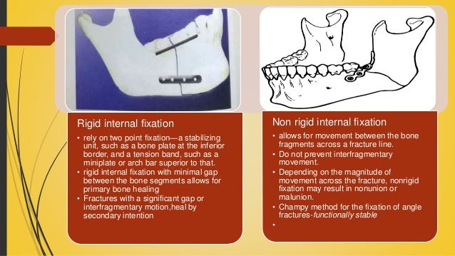 Rigid internal fixations