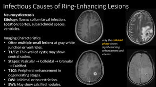 Ring-Enhancing Lesions of the MRI brain.pptx