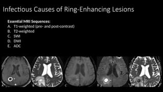 Ring-Enhancing Lesions of the MRI brain.pptx