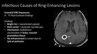 Ring-Enhancing Lesions of the MRI brain.pptx