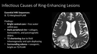 Ring-Enhancing Lesions of the MRI brain.pptx