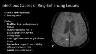 Ring-Enhancing Lesions of the MRI brain.pptx