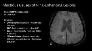 Ring-Enhancing Lesions Differentiation with MRI.pptx