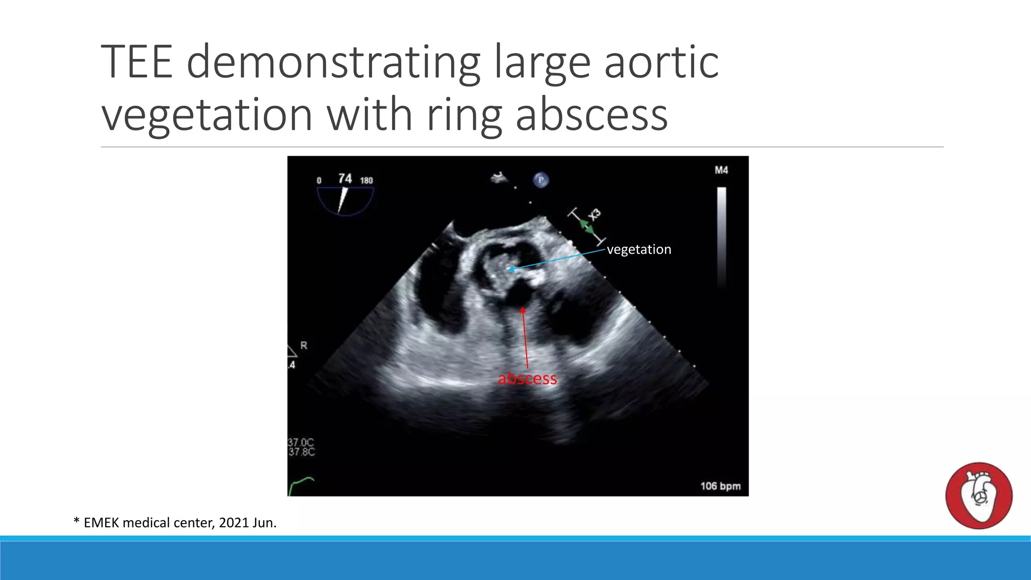 Paravalvular abscess in infective endocarditis | PPTX | Heart and ...