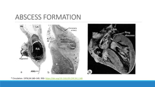 Paravalvular abscess in infective endocarditis | PPTX | Heart and ...