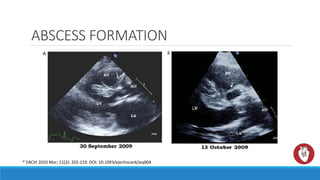 Paravalvular abscess in infective endocarditis | PPTX | Heart and ...