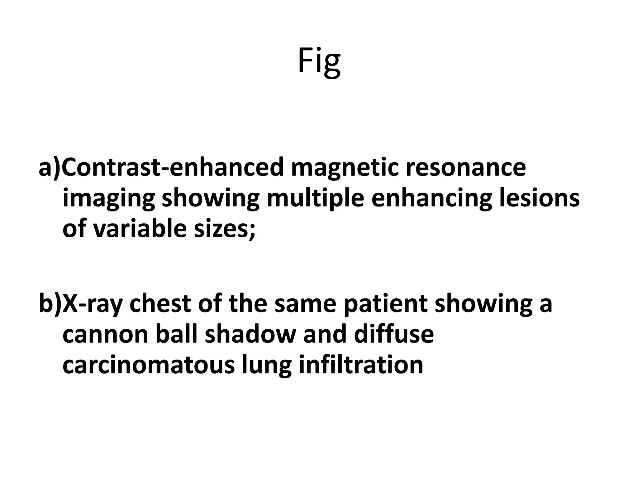 Ring enhancing lesions | PPTX