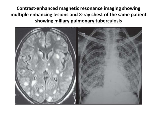 Ring enhancing lesions | PPTX | Brain and Nervous System Disorders ...