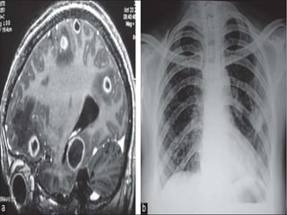 Ring enhancing lesions | PPT