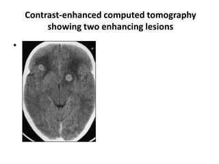 Ring enhancing lesions | PPT