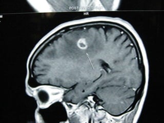 CT - Ring Enhancing Lesion | PPTX