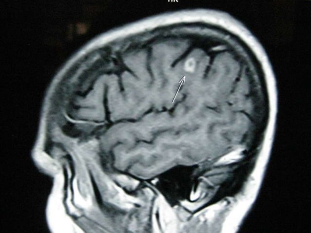 CT - Ring Enhancing Lesion | PPTX