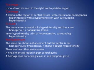 CT - Ring Enhancing Lesion | PPTX