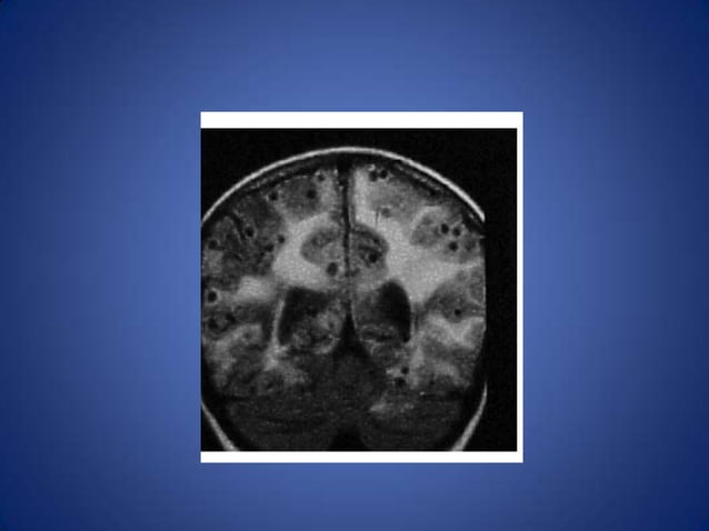 CT - Ring Enhancing Lesion | PPTX