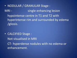 CT - Ring Enhancing Lesion | PPTX