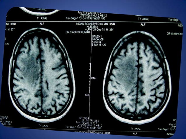CT - Ring Enhancing Lesion | PPTX