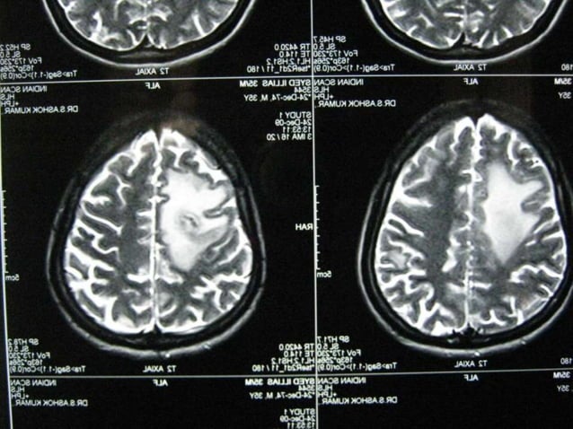 CT - Ring Enhancing Lesion | PPTX