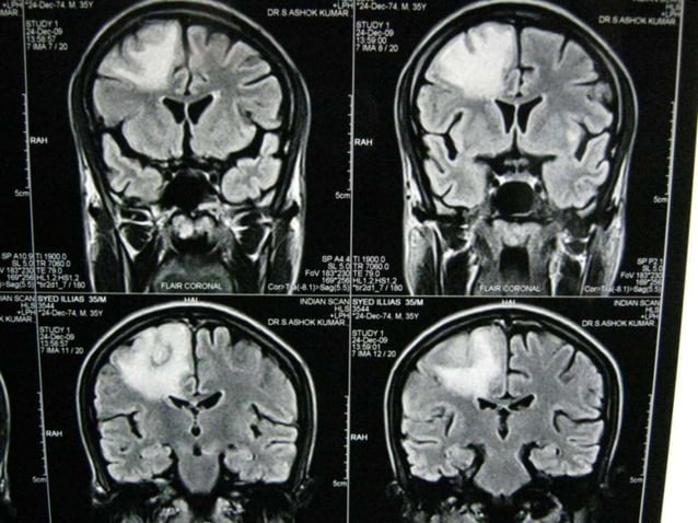 CT - Ring Enhancing Lesion | PPTX