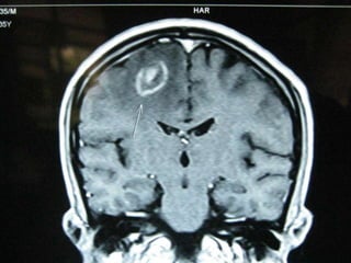 CT - Ring Enhancing Lesion | PPTX