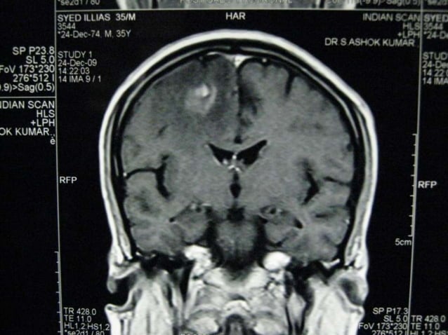 CT - Ring Enhancing Lesion | PPTX