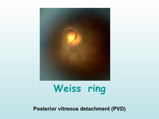 Rings, Dots, Lines & Spots | PPT