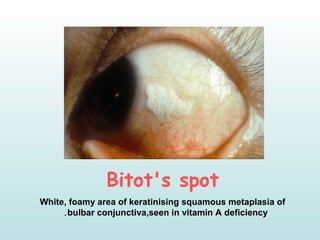 Bitots Spots