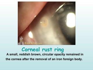 Cornea Iron Line On