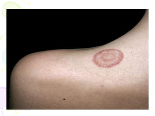 Ringworm | PPT