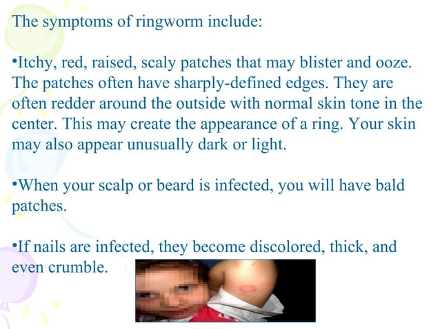 Ringworm | PPT | Skin and Dermatology | Diseases and Conditions