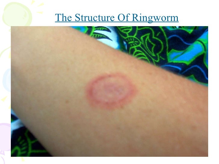 Ringworm
