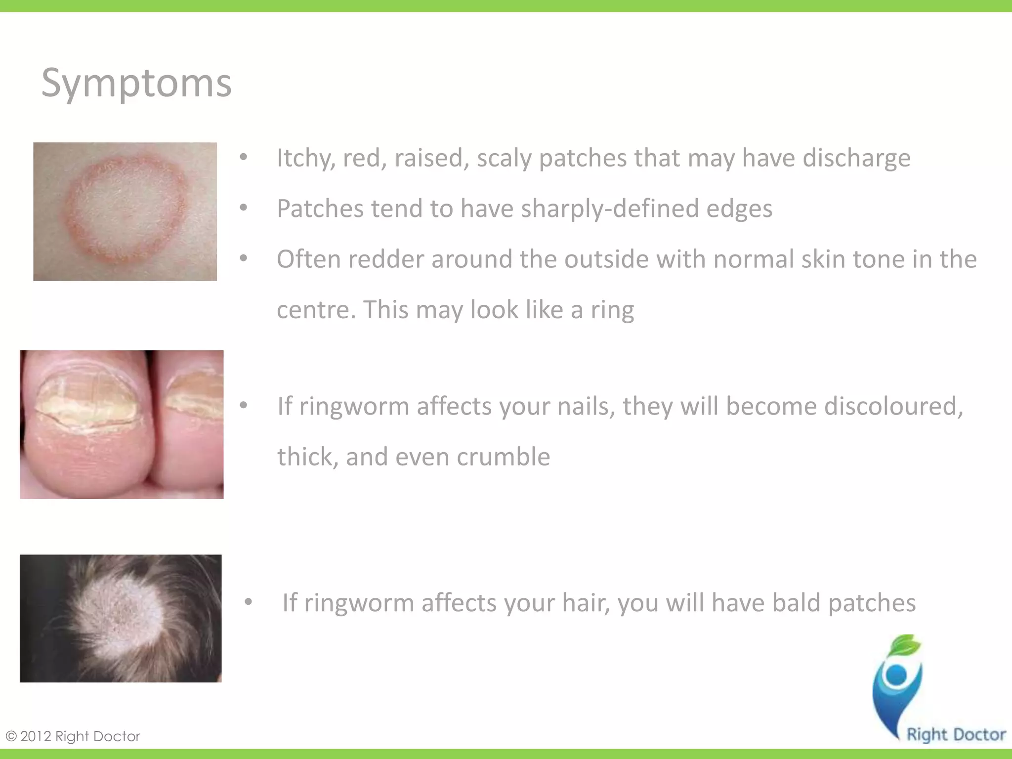 Ringworm | PPTX