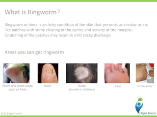 Ringworm | PPTX