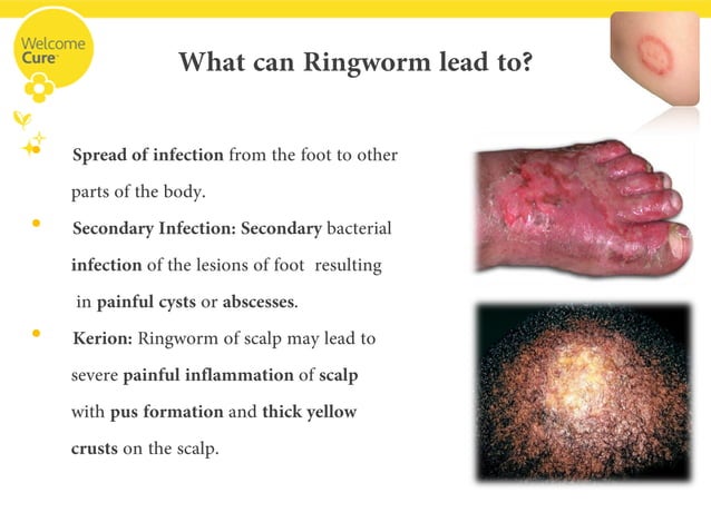 Treating Ringworm Infection, Achieving Flawless skin with Homeopathy! | PPT