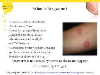 Treating Ringworm Infection, Achieving Flawless skin with Homeopathy! | PDF