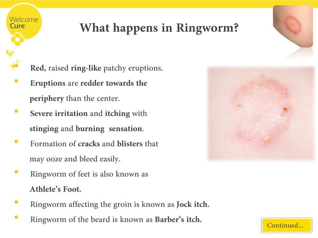 Treating Ringworm Infection, Achieving Flawless skin with Homeopathy! | PPT