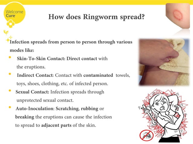 Treating Ringworm Infection, Achieving Flawless skin with Homeopathy! | PPT
